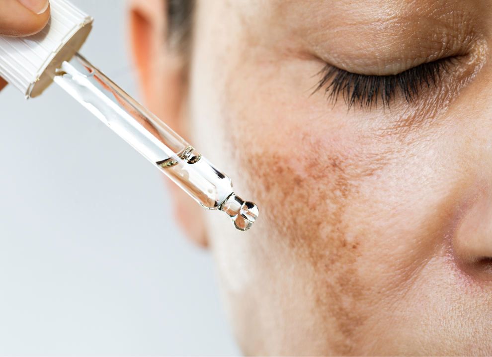 Melasma: o que é, causas e tratamento - Magnetik Alchemy